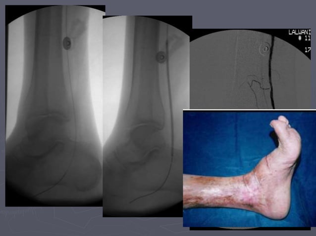 Endovascular Interventions Endovascular Therapy Endovascular Angioplasty Ppt
