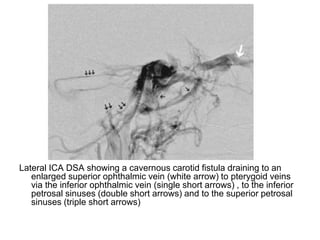 Endovascular management of carotid cavernous fistula | PPT