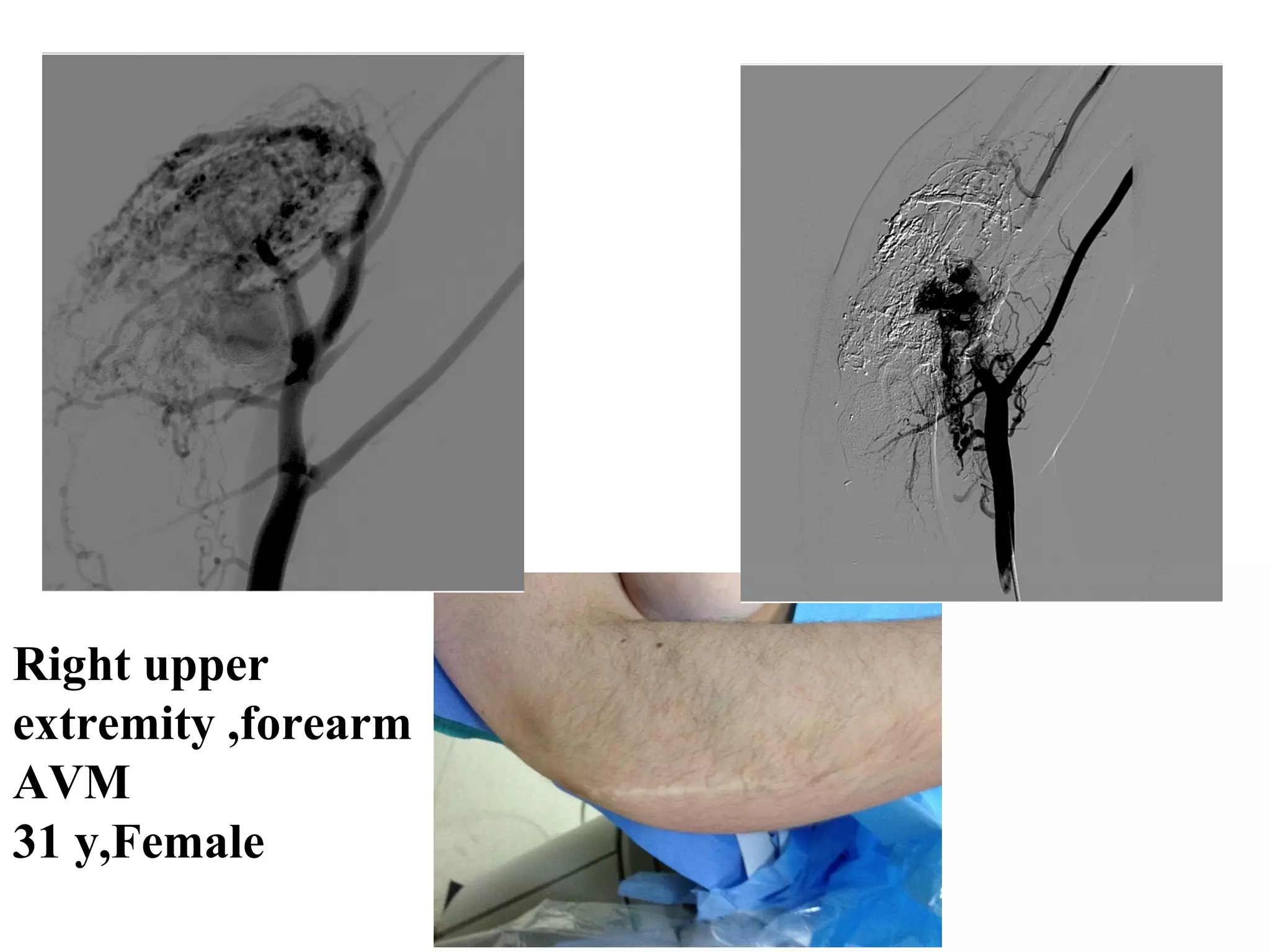 Endovascular management of complex vascular malformations | PPT
