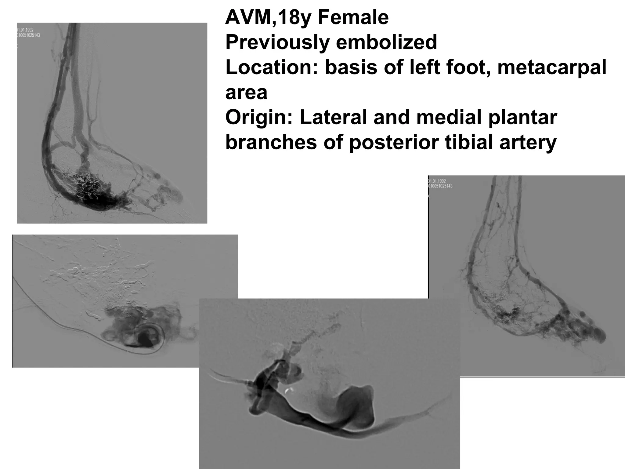 Endovascular management of complex vascular malformations | PPT ...