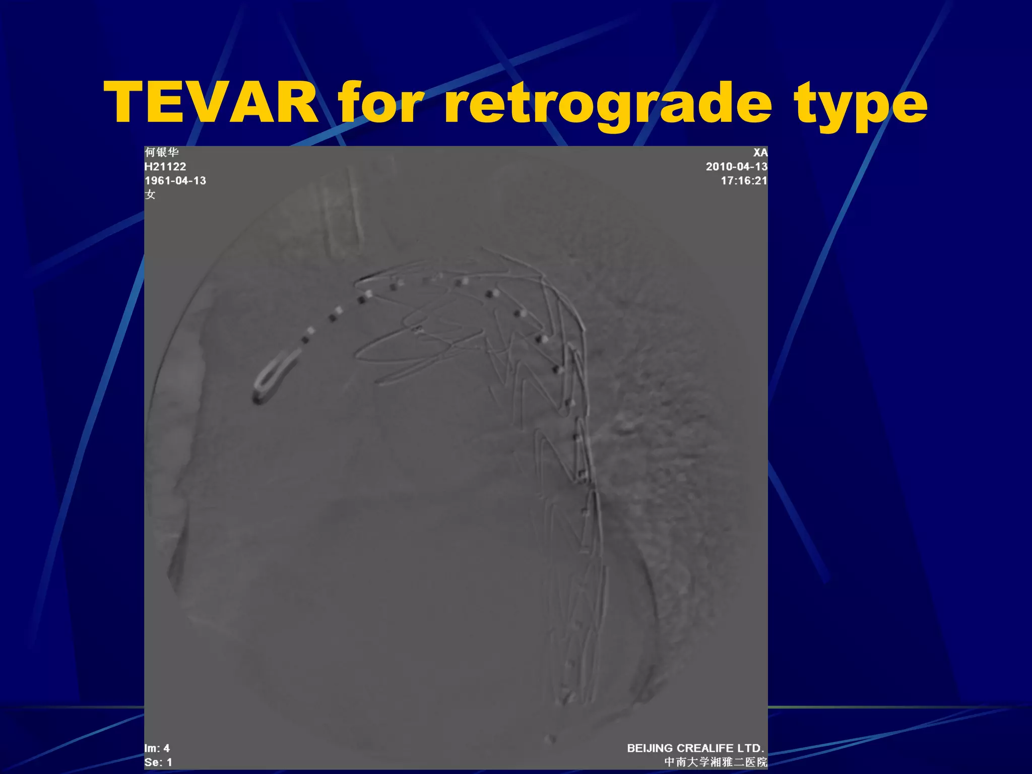 Endovascular repair for type b aortic dissection with viscer | PPT