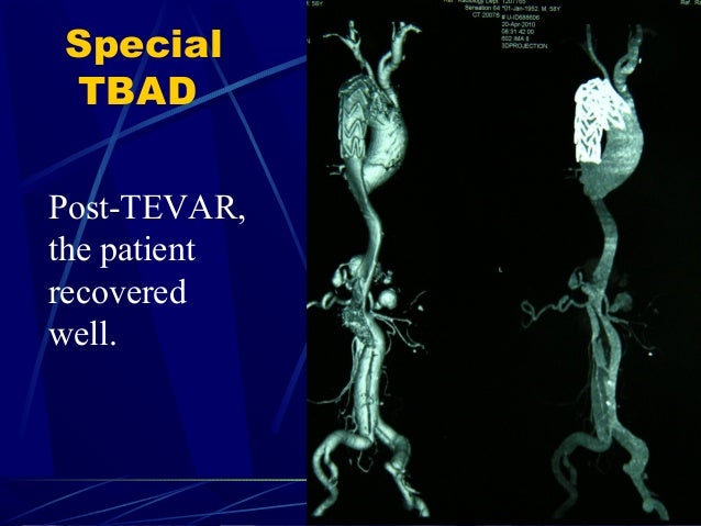 Endovascular repair for type b aortic dissection with viscer