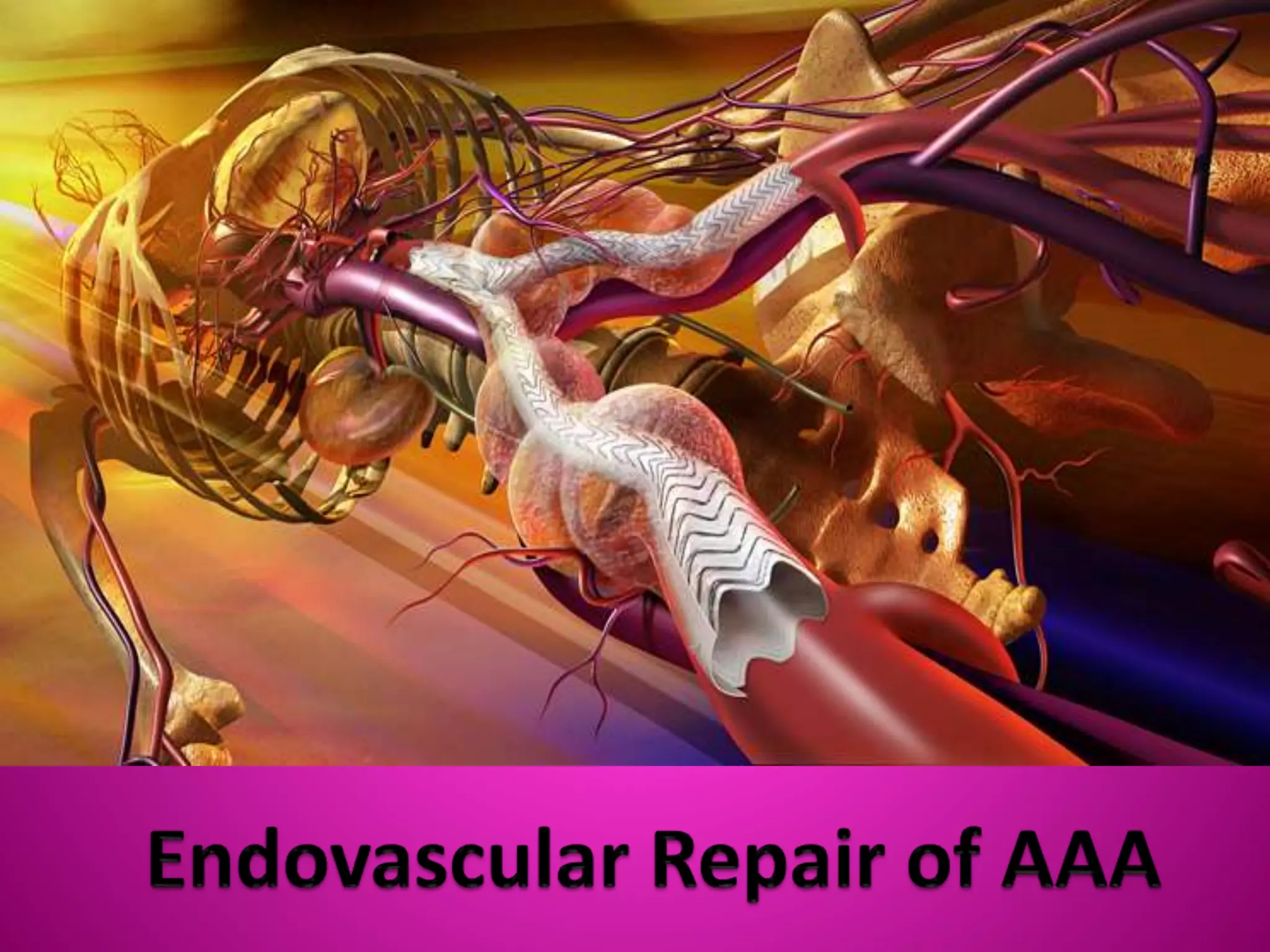 EVAR - Nicola Tanner | PPTX