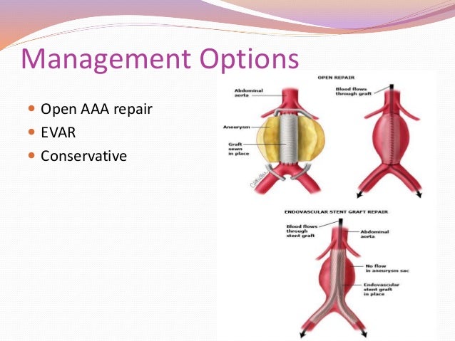 EVAR - Nicola Tanner