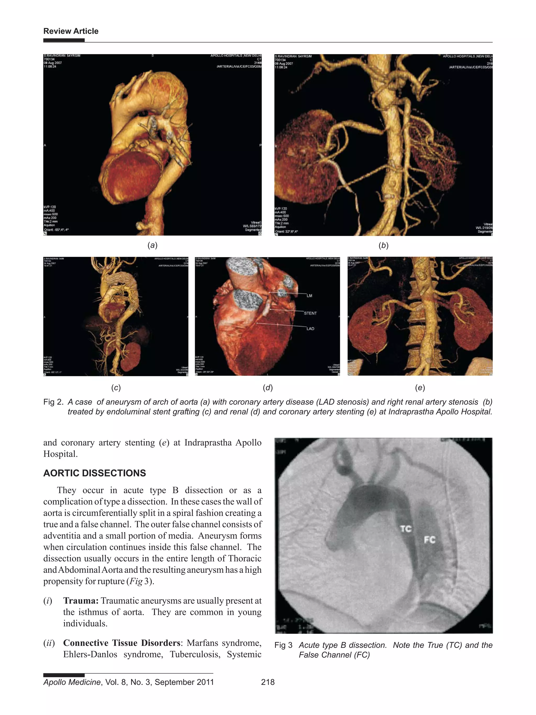 Endovascular repair of thoracic and abdominal aortic aneurysms | PDF