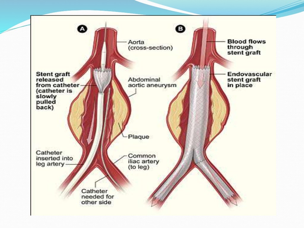 Endovascular surgery
