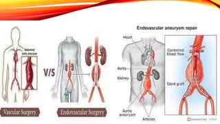 endovascular surgery.pptx