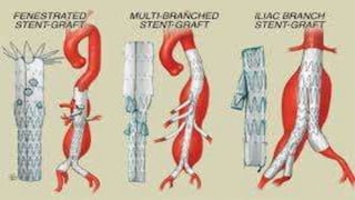 endovascular surgery.pptx