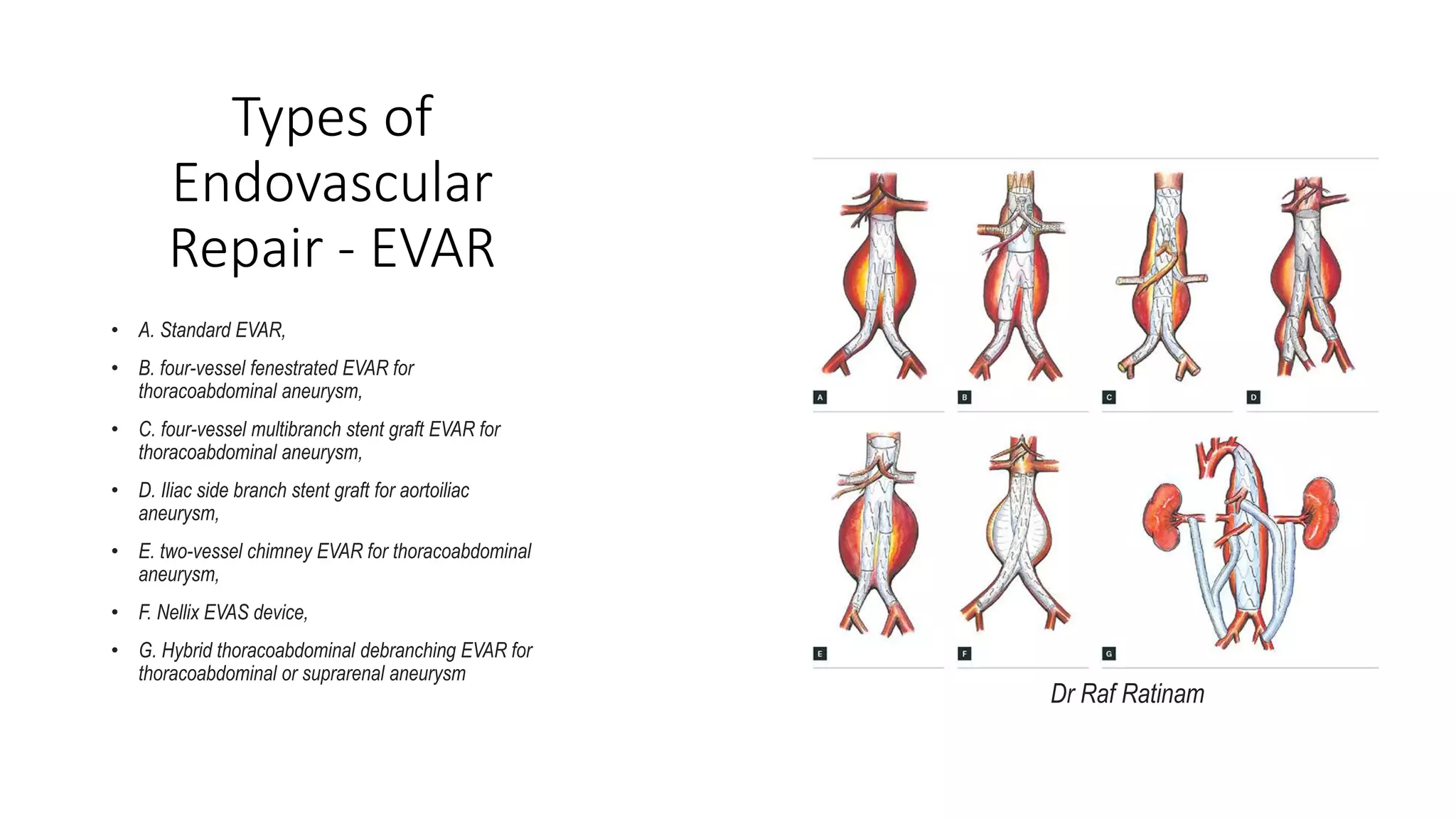Endovascular Surgery of Abdominal Aorta | PPSX