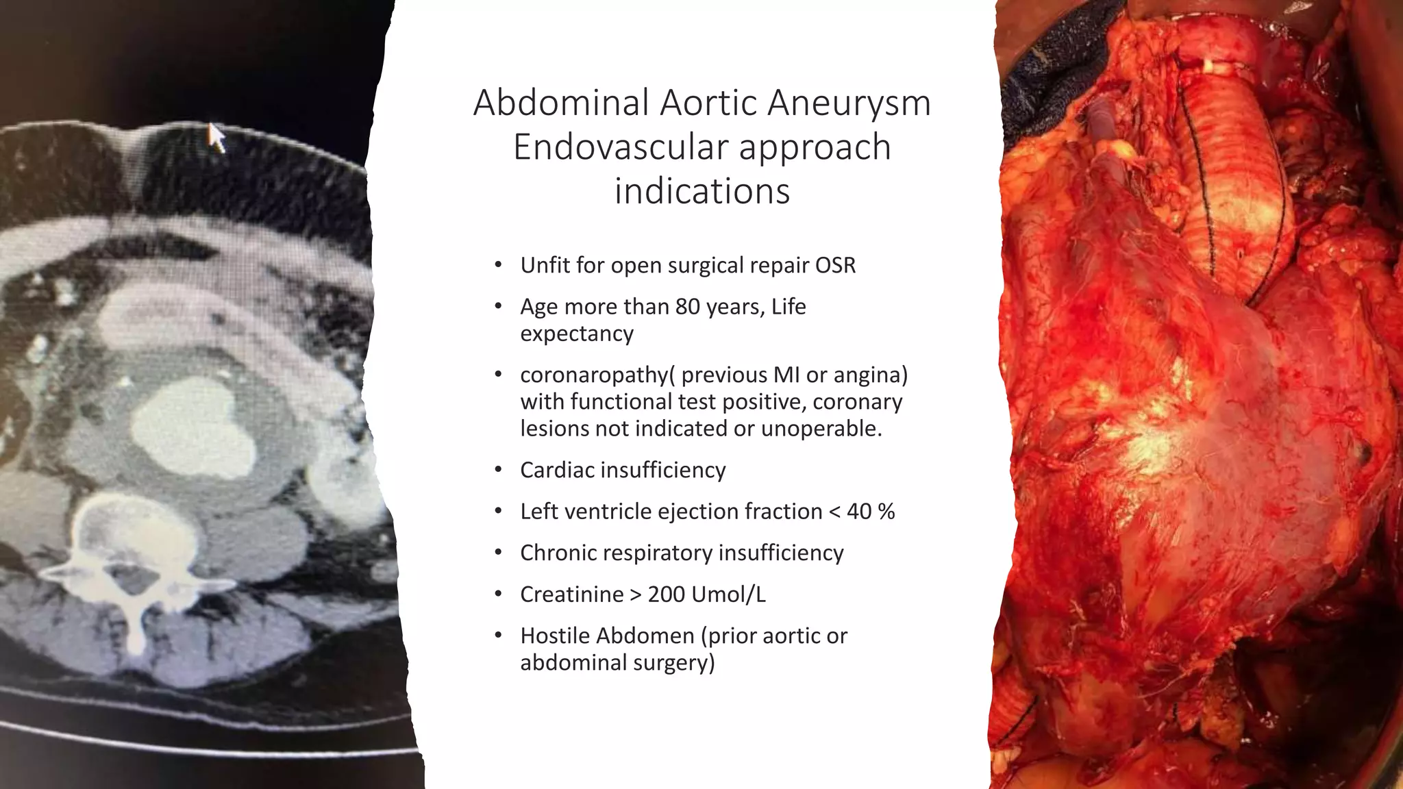 Endovascular Surgery of Abdominal Aorta | PPSX