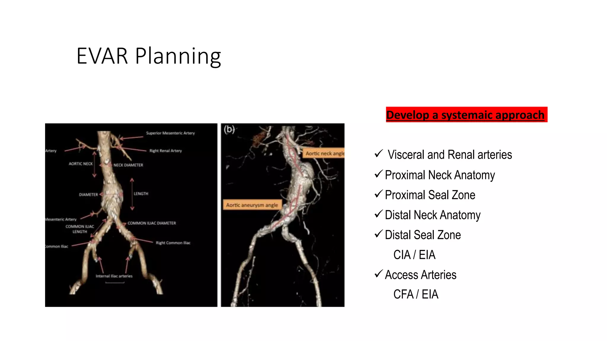 Endovascular Surgery of Abdominal Aorta | PPSX