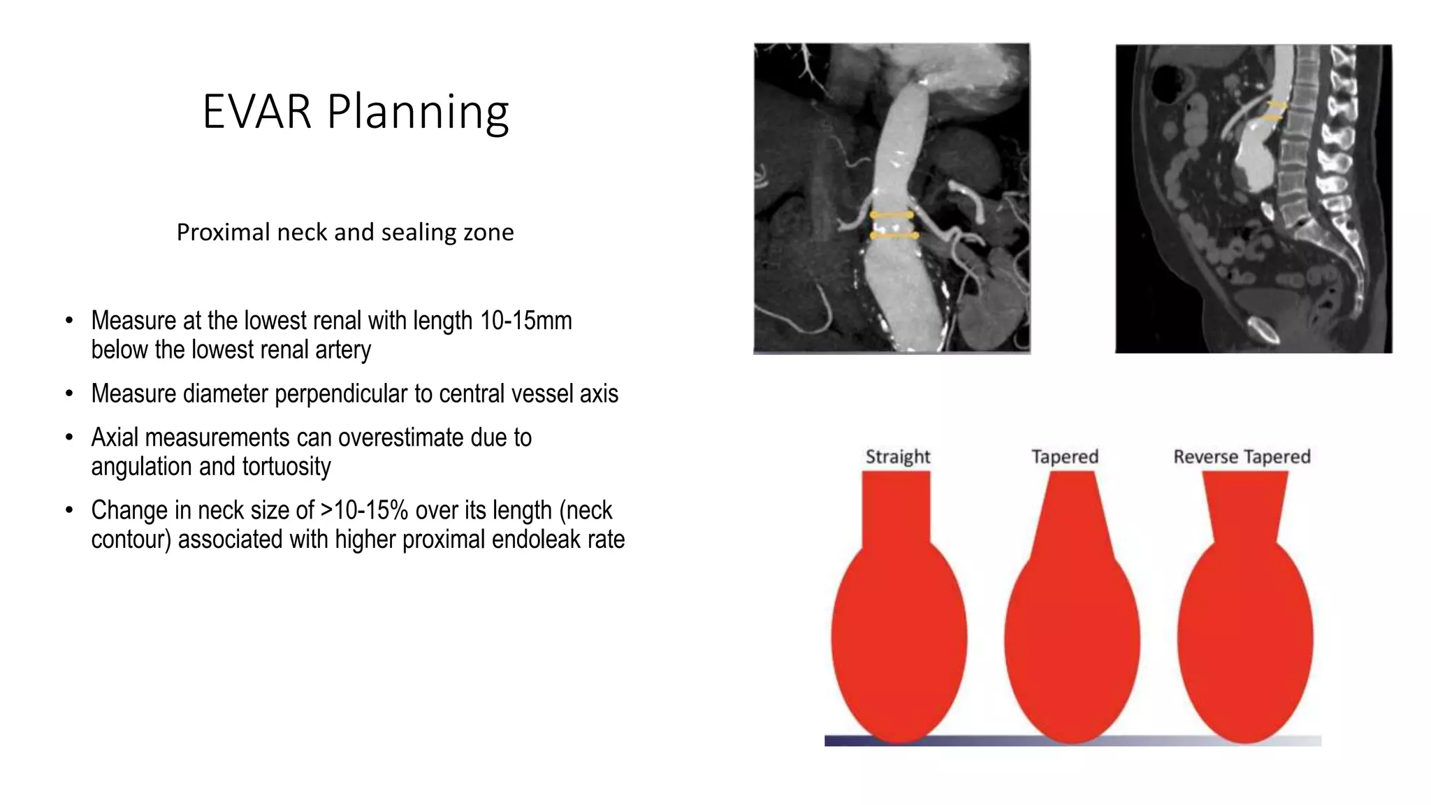 Endovascular Surgery of Abdominal Aorta | PPSX