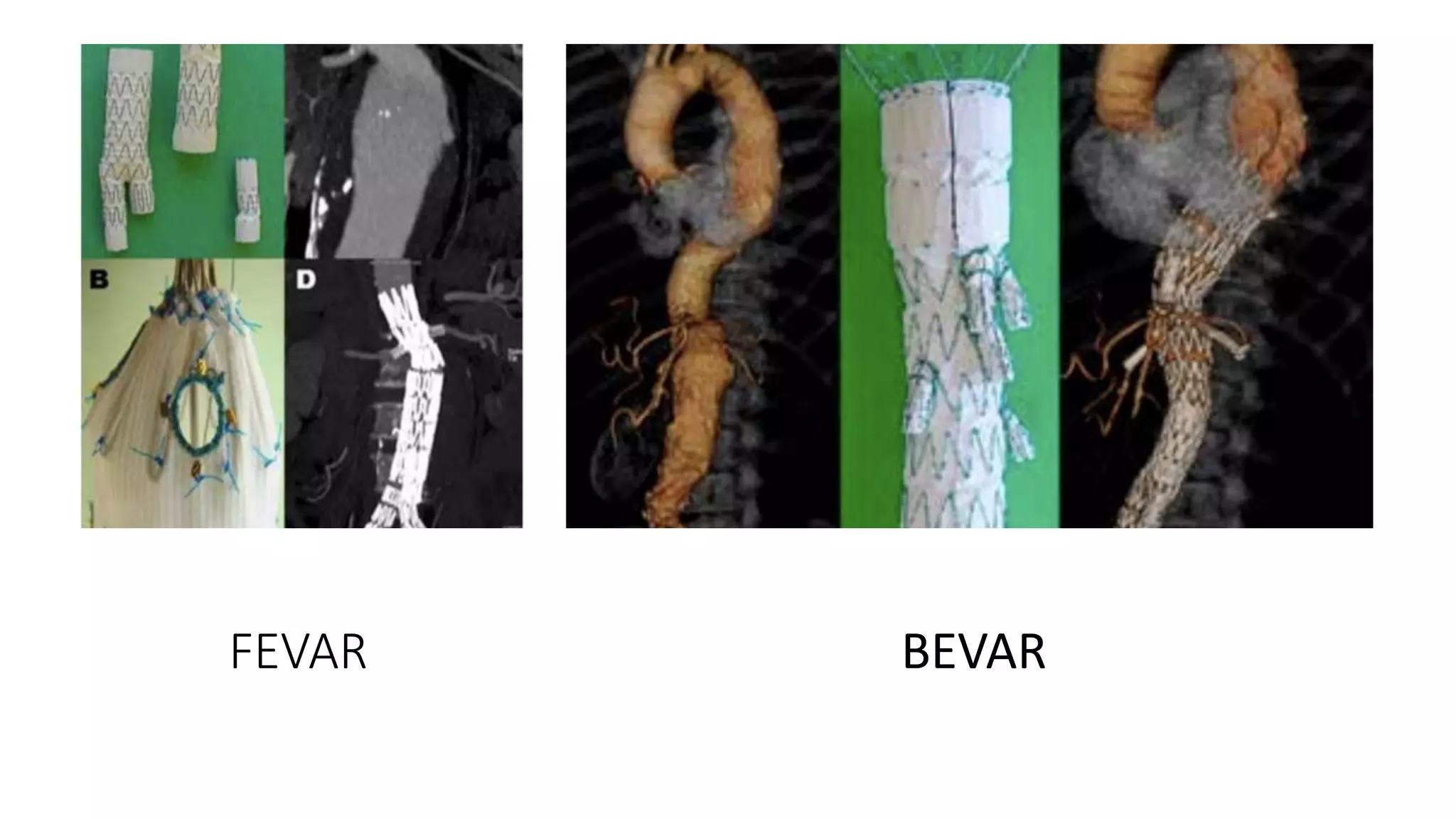 Endovascular Surgery of Abdominal Aorta | PPSX