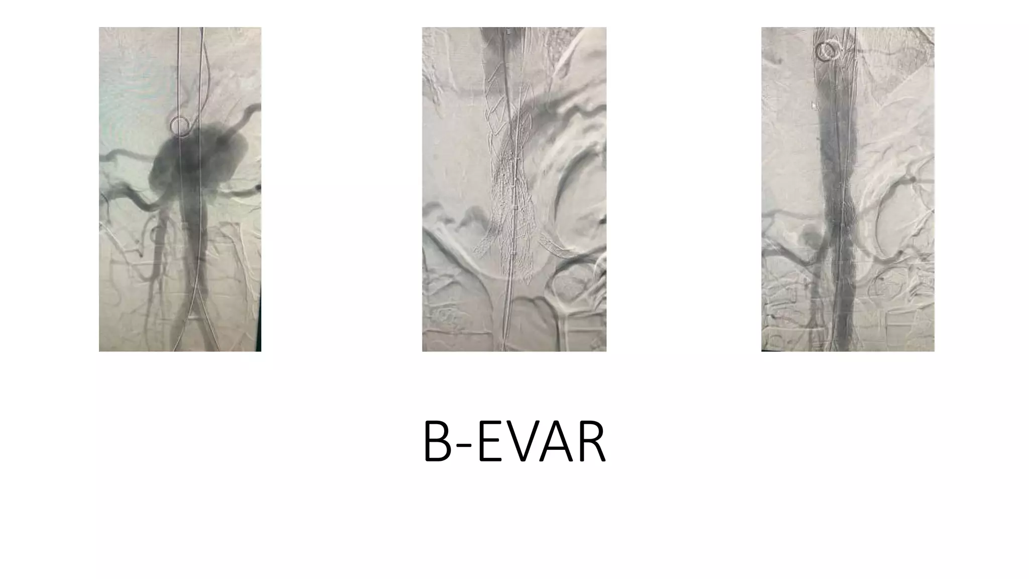 Endovascular Surgery of Abdominal Aorta | PPSX