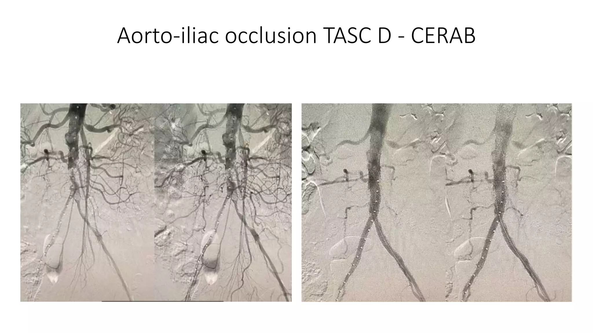 Endovascular Surgery of Abdominal Aorta | PPSX