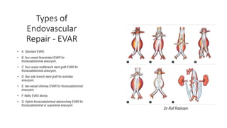 Endovascular Surgery of Abdominal Aorta | PPSX
