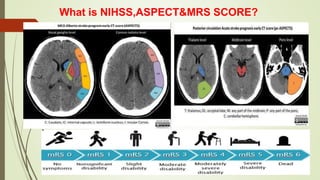 Endovascular therapy Neuro intervention (MT) in AIS Dr Ganesh.pptx