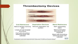 Endovascular therapy Neuro intervention (MT) in AIS Dr Ganesh.pptx