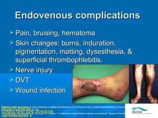 Endovenous laser ablation | PPT