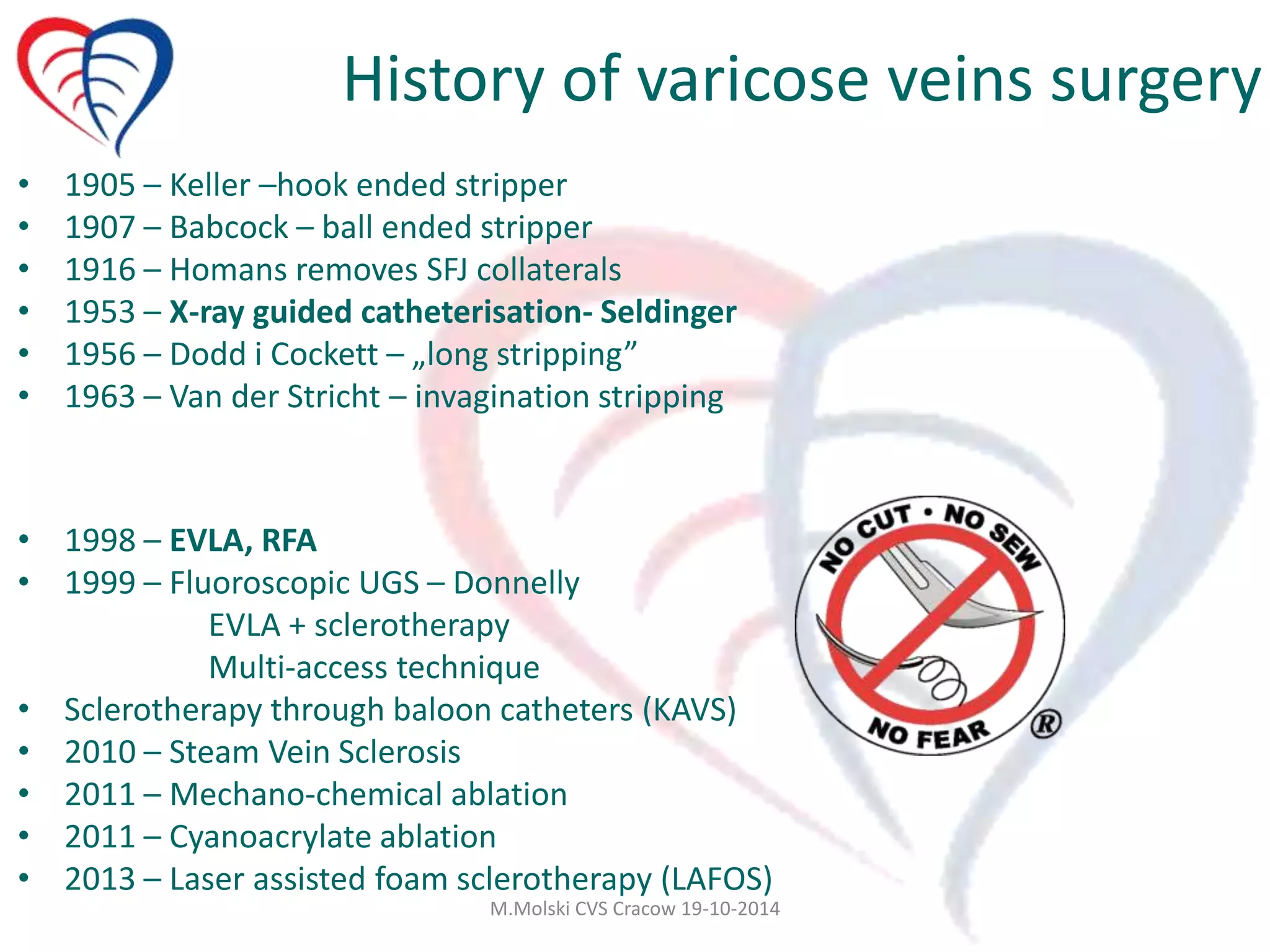 Endovenous treatment for varicose veins – the first choice (laser ...