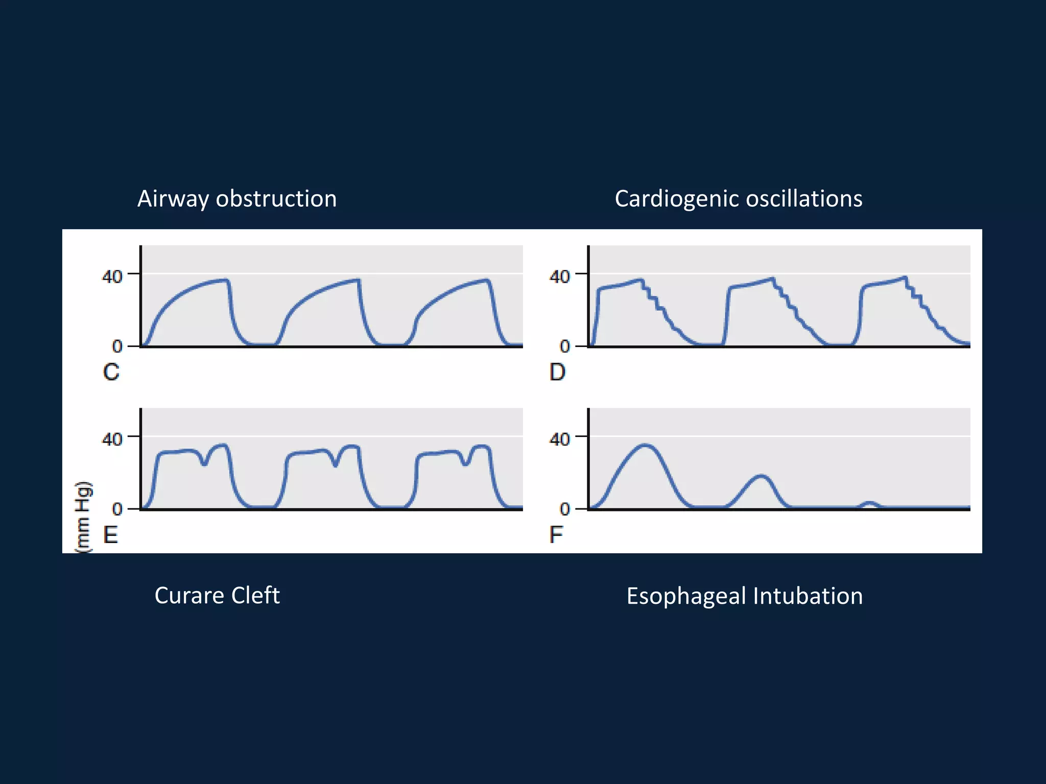 End tidal co2 and transcutaneous monitoring | PPTX