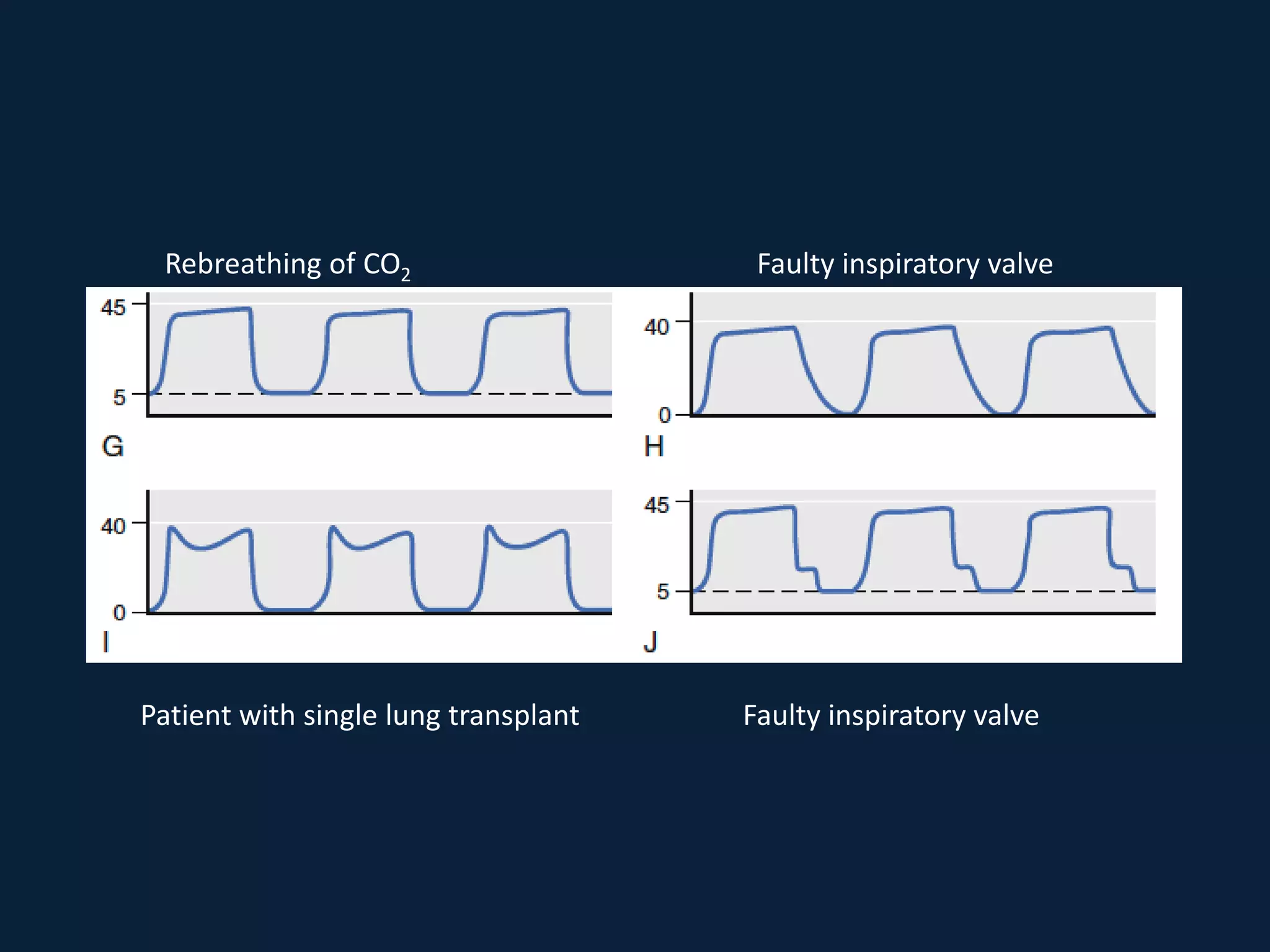 End tidal co2 and transcutaneous monitoring | PPTX