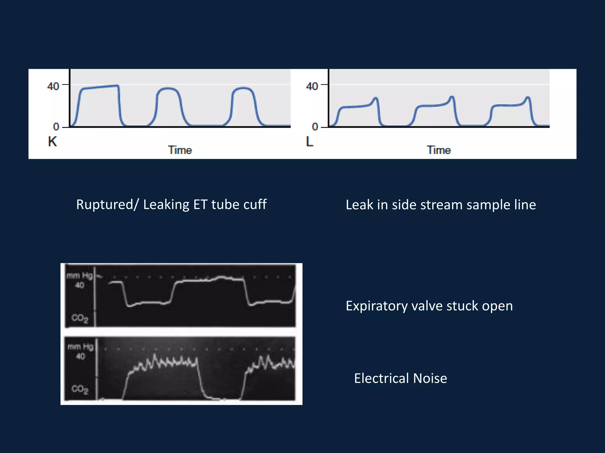 End tidal co2 and transcutaneous monitoring | PPTX