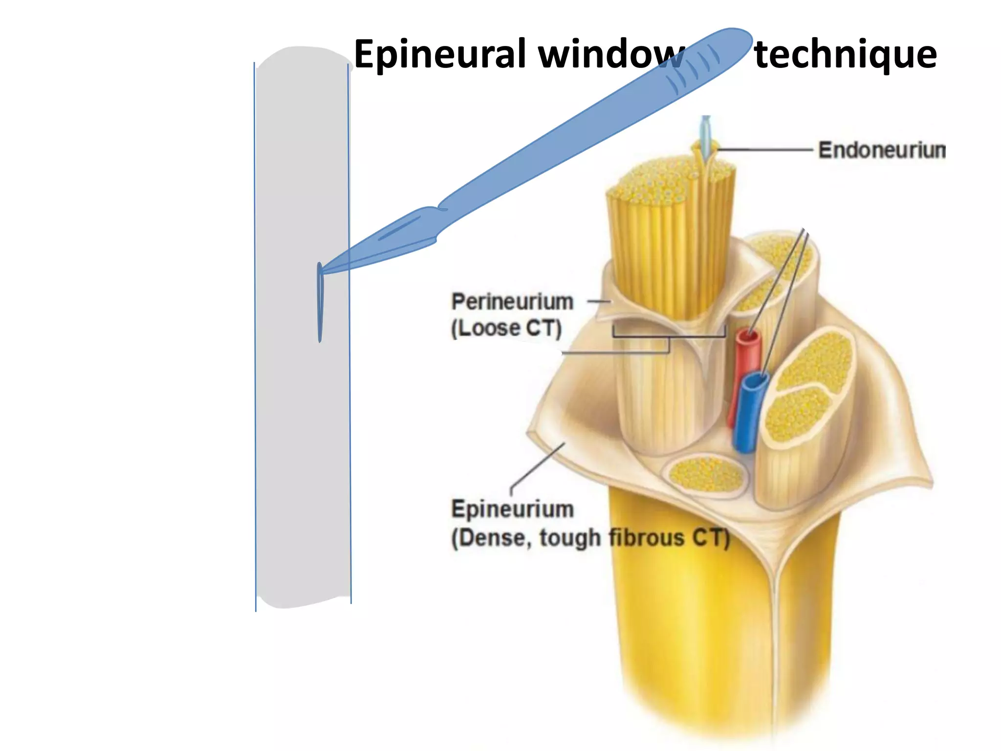 End to side nerve anastomosis & nerve conduits surgical technique ...