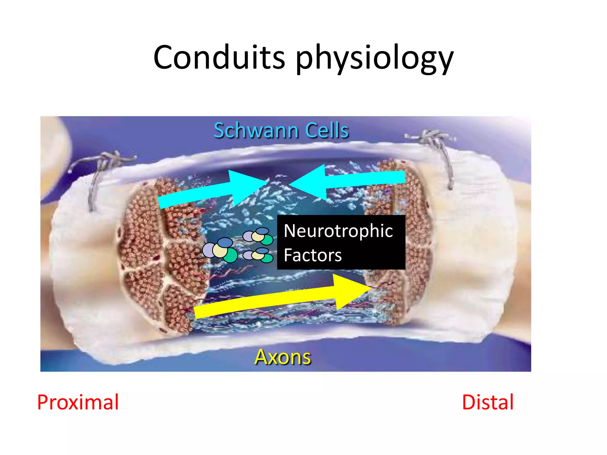 End to side nerve anastomosis & nerve conduits surgical technique ...