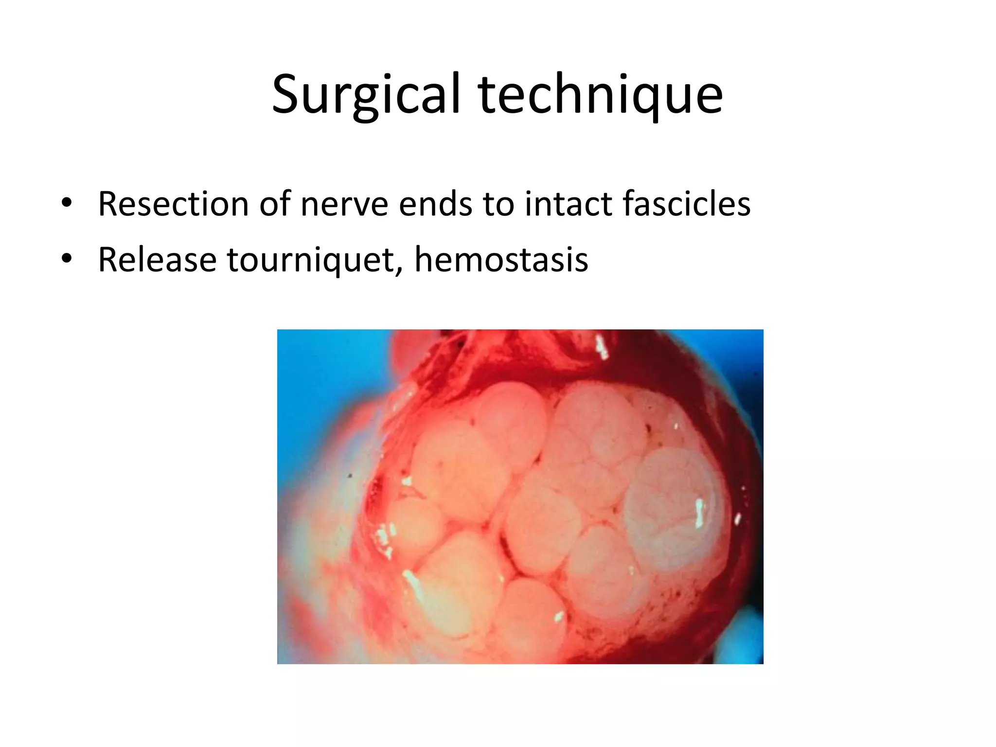 End to side nerve anastomosis & nerve conduits surgical technique ...