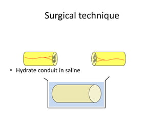End to side nerve anastomosis & nerve conduits surgical technique ...