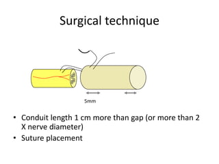 End to side nerve anastomosis & nerve conduits surgical technique ...
