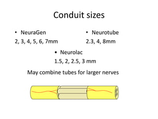 End to side nerve anastomosis & nerve conduits surgical technique ...