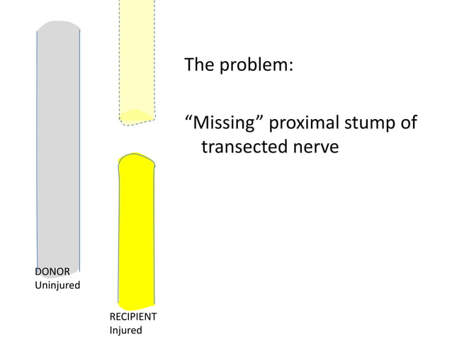 End to side nerve anastomosis & nerve conduits surgical technique ...