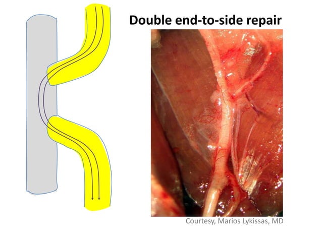 End to side nerve anastomosis & nerve conduits surgical technique attikon 2013 | PPTX | Death ...