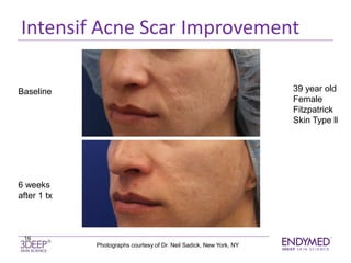 INTENSIF RFMN Before and Afters | PDF