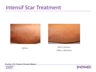 INTENSIF RFMN Before and Afters | PDF