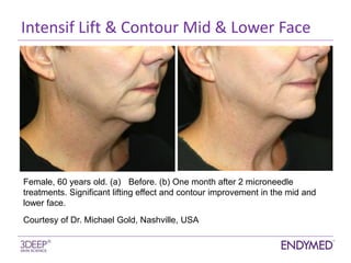 INTENSIF RFMN Before and Afters | PDF