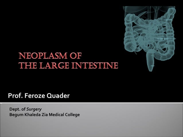 Neoplasm of Large Intestine | PPT | Digestive Disorders | Diseases and ...