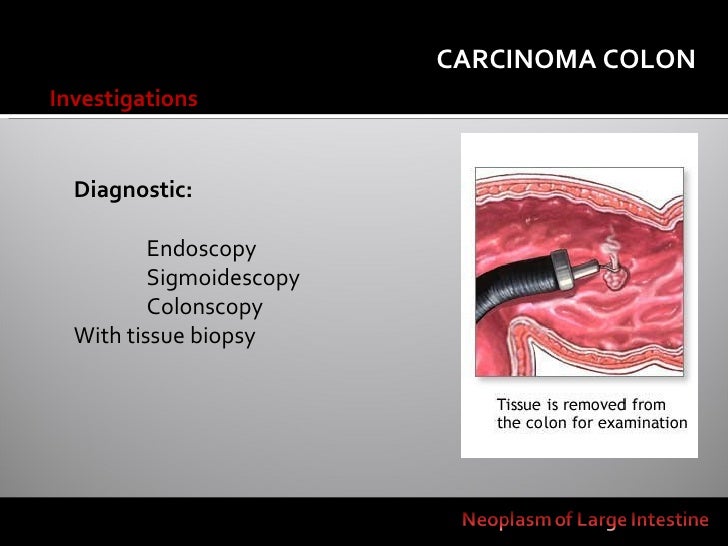 Neoplasm of Large Intestine