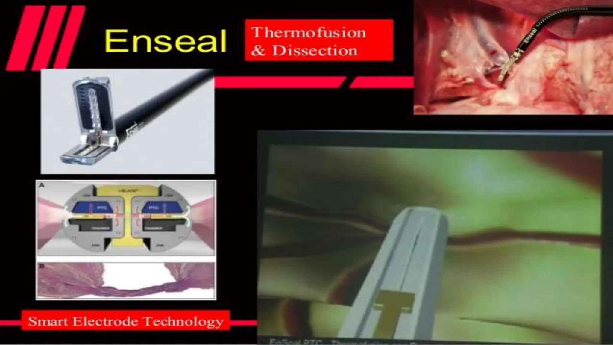 Energy source used in laparoscopic surgery(1) (1).pptx