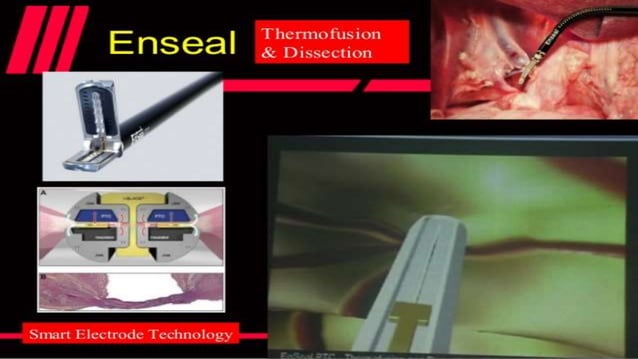 Energy source used in laparoscopic surgery(1) (1).pptx