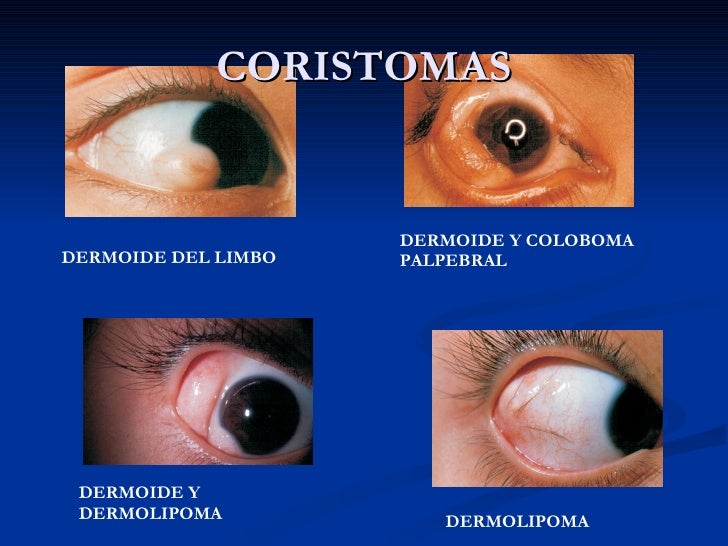 Enfe Externas Del Ojo