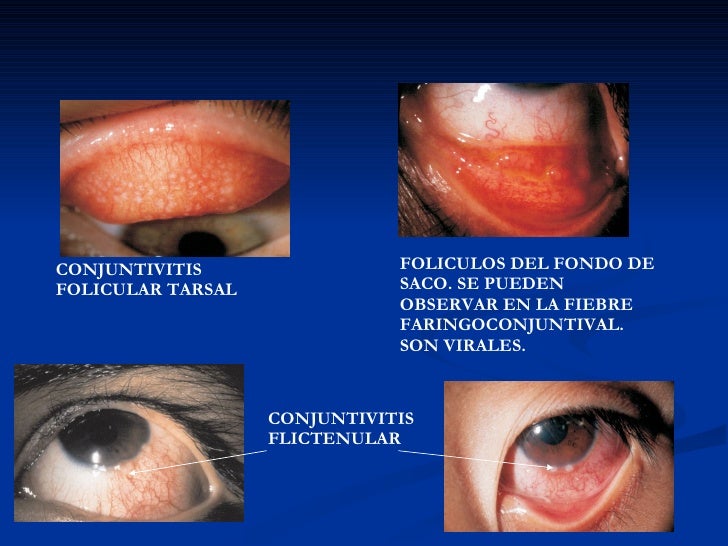 Enfe Externas Del Ojo