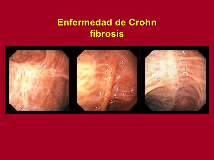 Enfermedad De Crohn