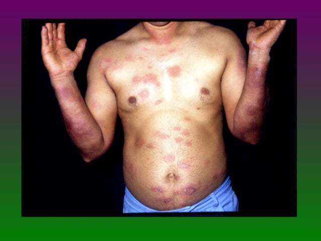 Enfermedad De Hansen O Lepra