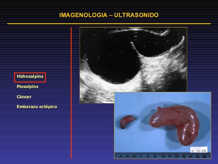 Enfermedad Pelviana Inflamatoria