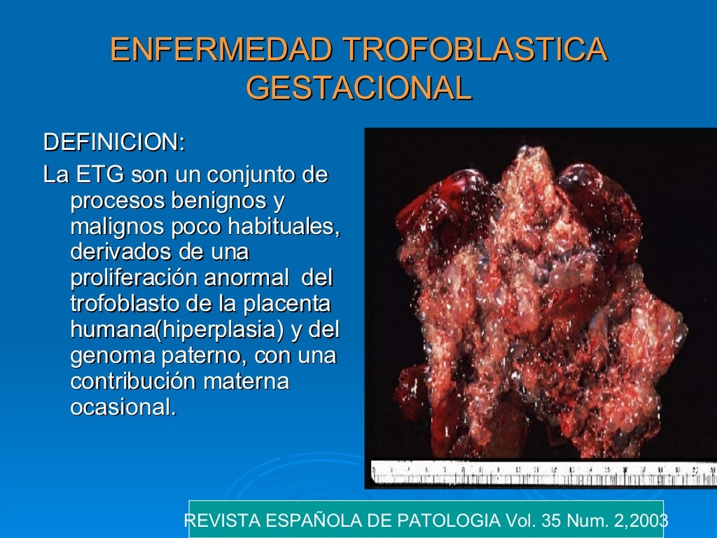 ENFERMEDAD TROFOBLASTICA GESTACIONAL