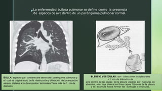 ENFERMEDAD BULLOSA PULMONAR.pptx