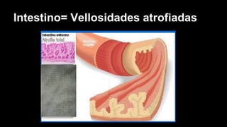 Enfermedad celiaca | PDF